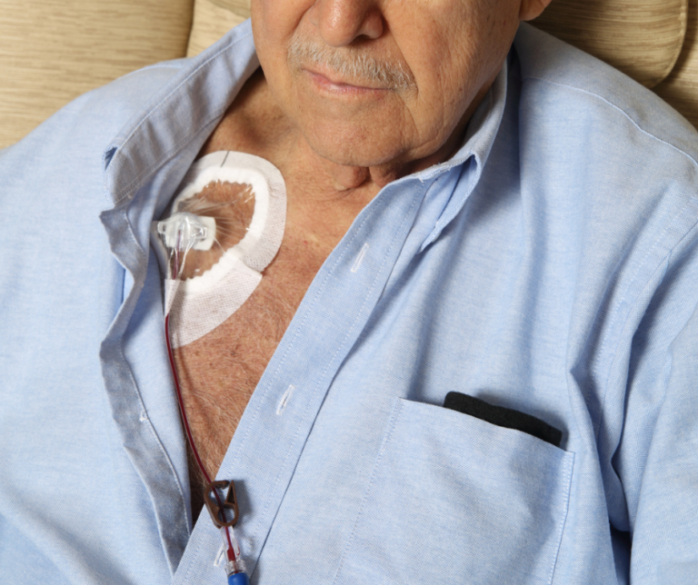 O que é Port-a-Cath? – ONCOSOUL